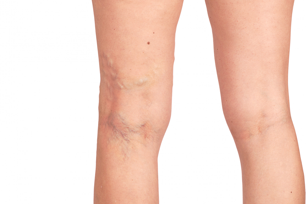 WHY YOU HAVE SPIDER VEINS AND WHAT TO DO ABOUT THEM | Westport ...